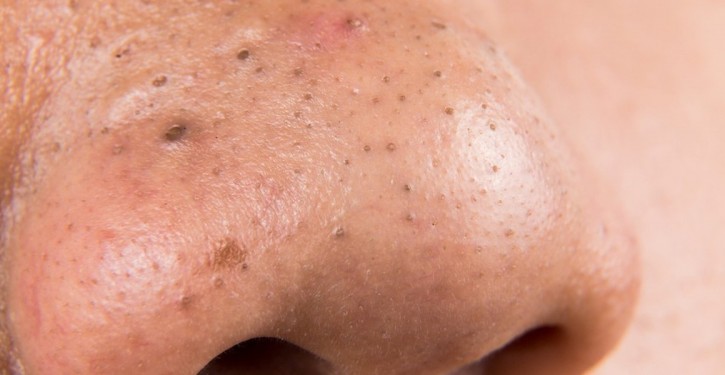 points-noirs-astuces - Alf.fr